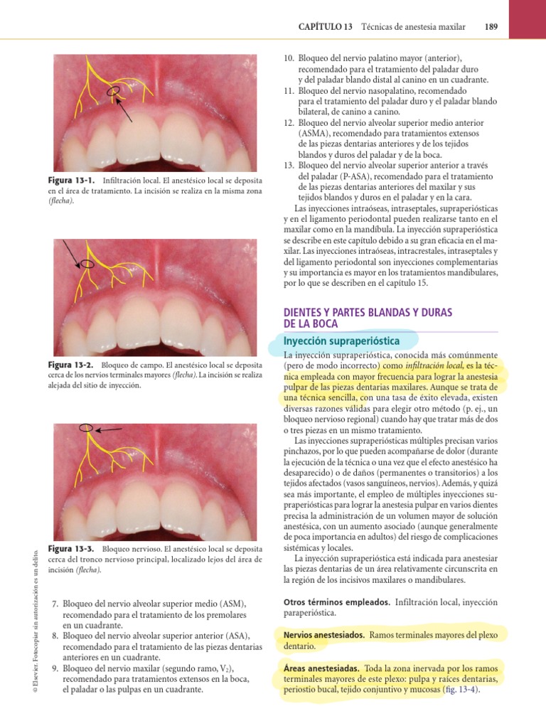 230manual de Anestesia Local Malamed 6 Ed | PDF | Inyección (medicina ...