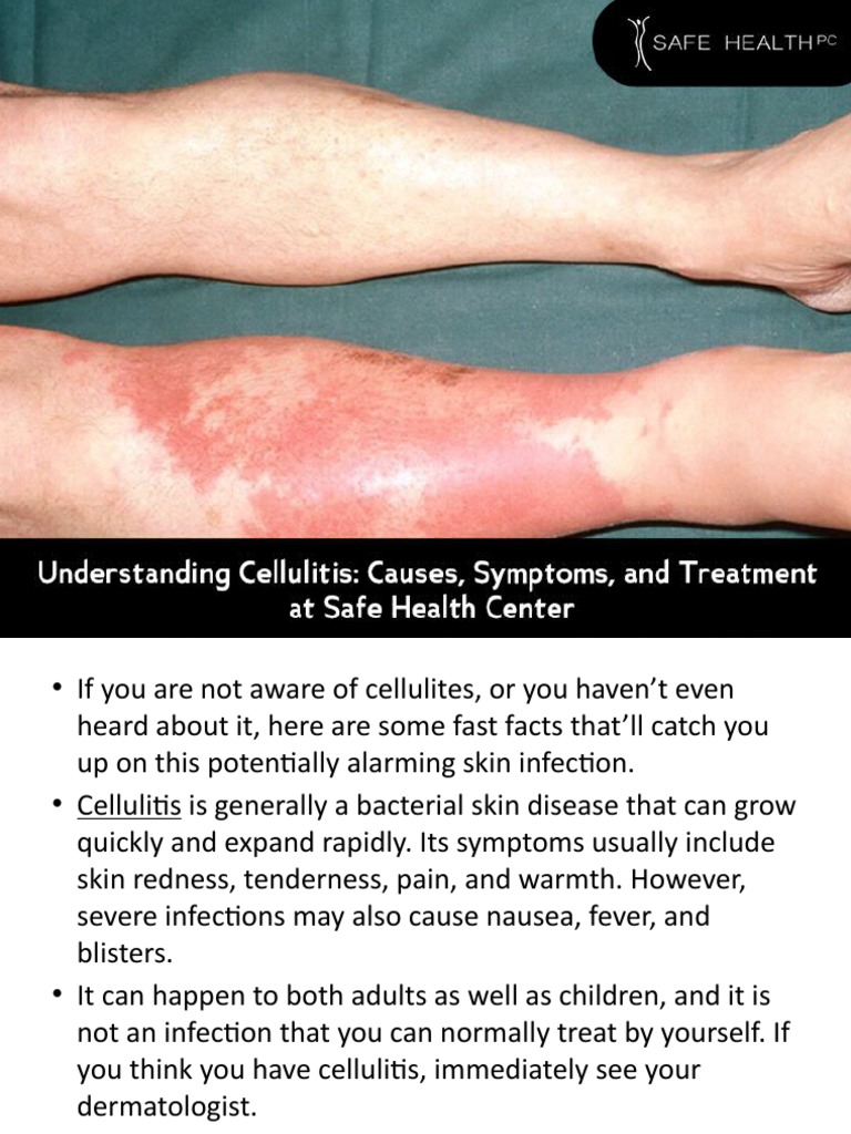 Understanding Cellulitis Risks | PDF | Wound | Diseases And Disorders