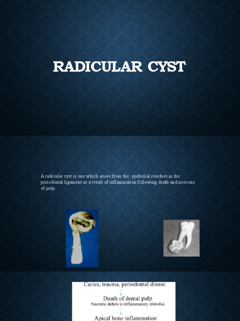 Radicular Cyst: Pathogenesis and Treatment | PDF | Clinical Medicine ...