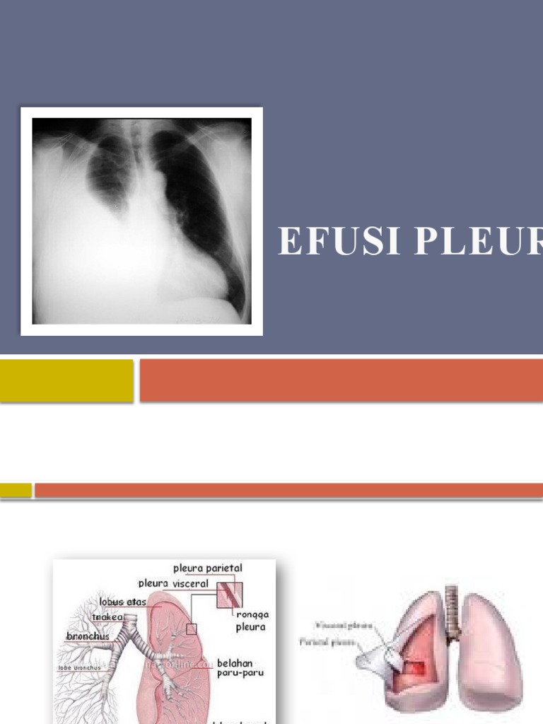 Efusi Pleura | PDF