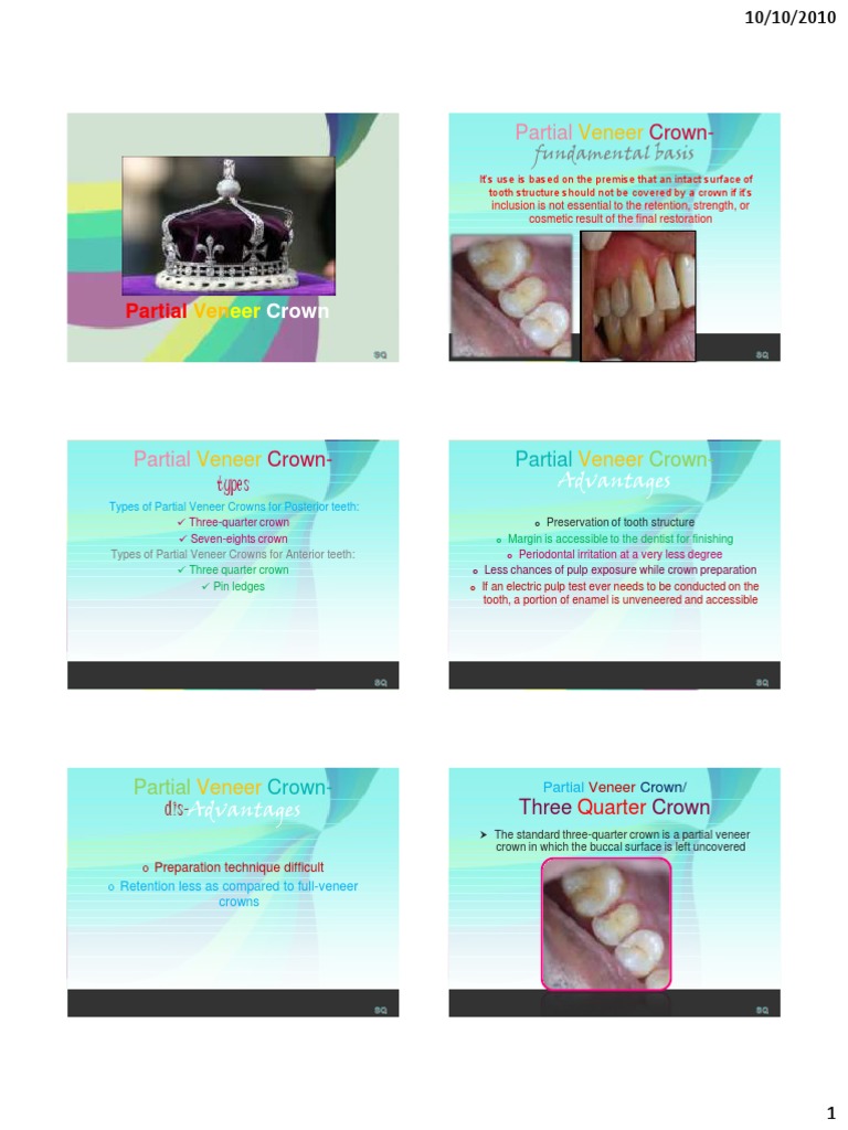Partial Veneer Crown Guide | PDF | Health Sciences | Medical Specialties