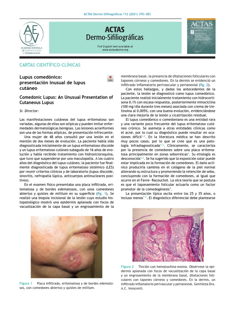 Cartas Científico-Clínicas: Lupus Comedónico: Presentación Inusual de Lupus Cutáneo | PDF ...