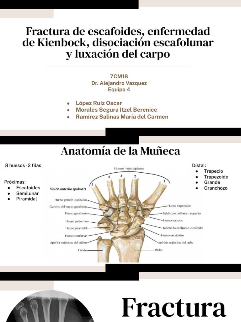 Fractura de Escafoides, Enfermedad de Kienbock, Disociación Escafolunar ...
