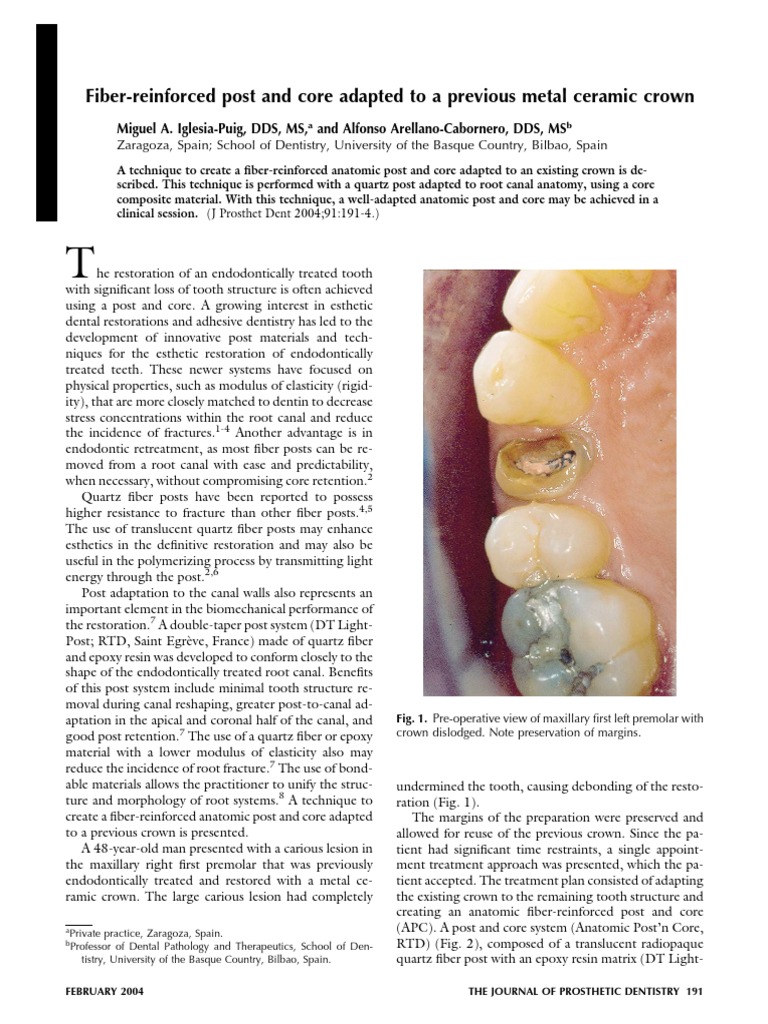 Fiber Reinforced Post and Core | PDF | Dental Implant | Dentures