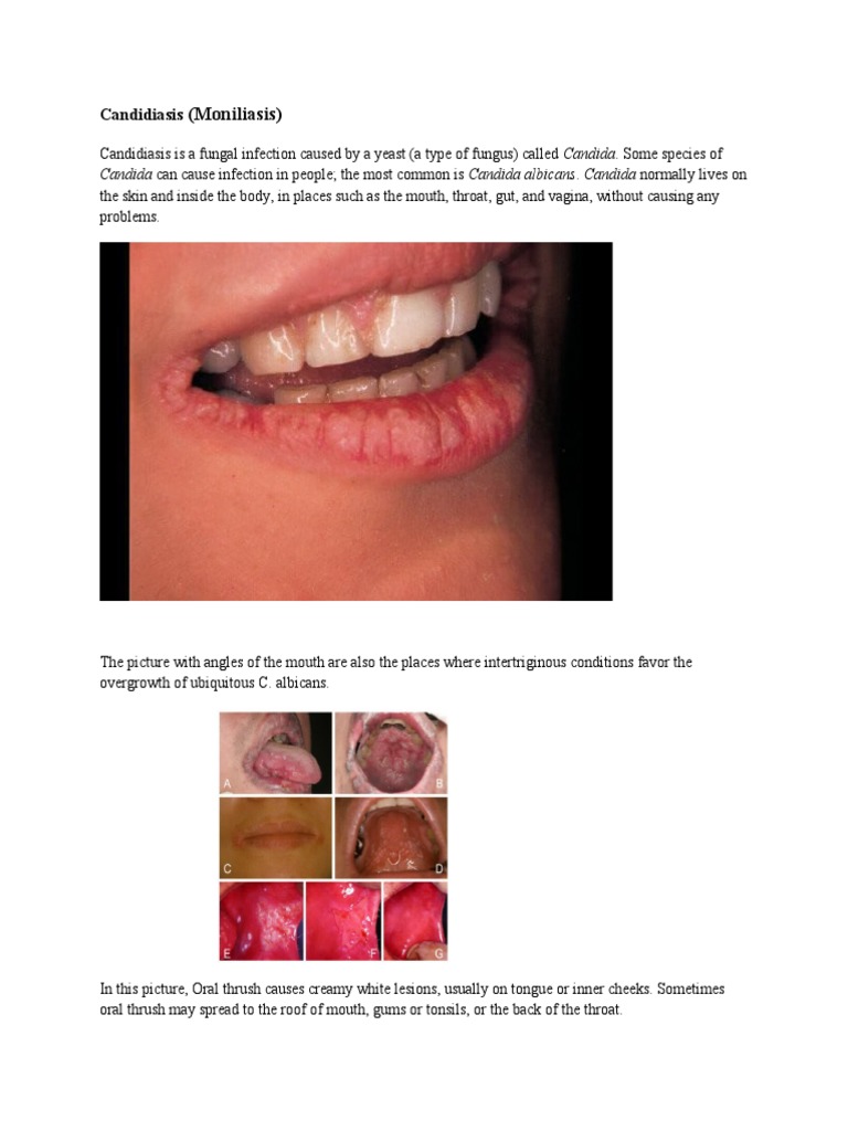 Opportunistic Mycoses | PDF | Candidiasis | Candida (Fungus)