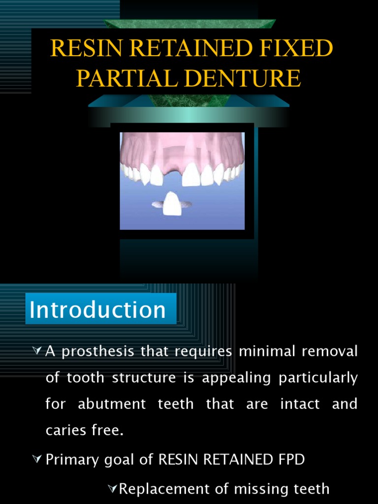 Resin Retained Fixed Partial Dentures | PDF | Physical Sciences | Chemistry