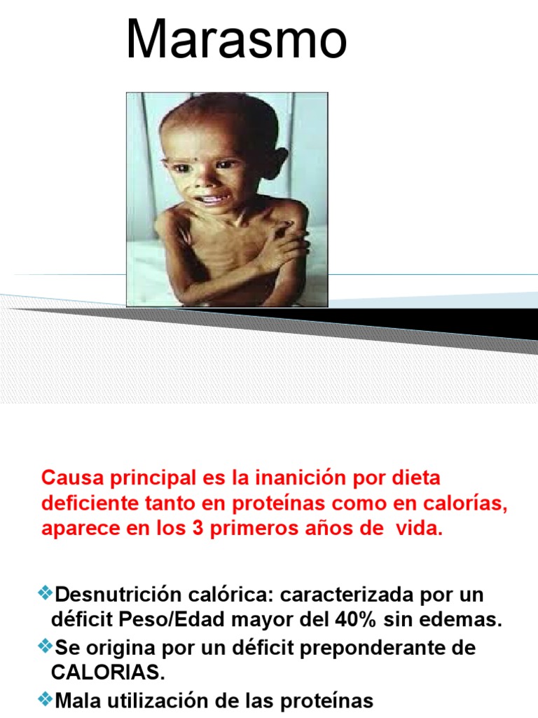 Marasmo: Desnutrición Calórica Infantil | PDF | Nutrición | Dieta y ...
