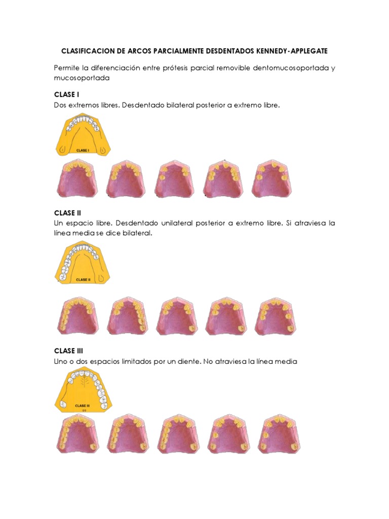 Clasificacion de Arcos Parcialmente Desdentados Kennedy-Applegate | PDF ...