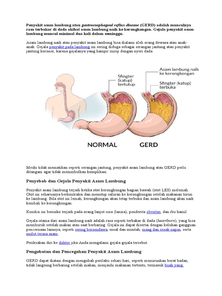 GERD | PDF