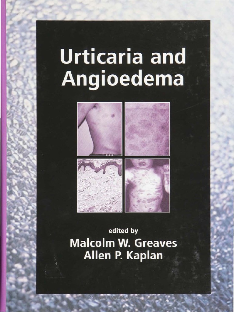 Malcolm W. Greaves, Allen Kaplan - Urticaria and Angioedema (2004) PDF | Download Free PDF ...