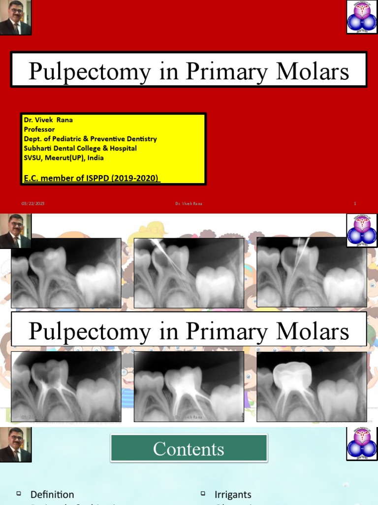 Pulpectomy in Primary Molars Final | PDF | Dentistry | Health Sciences