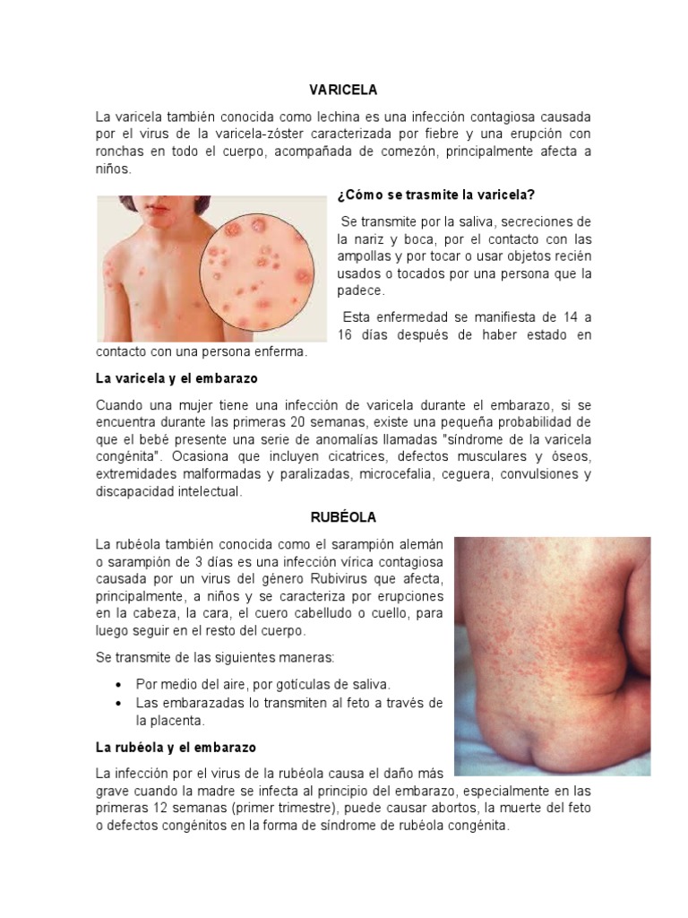 VARICELA | PDF