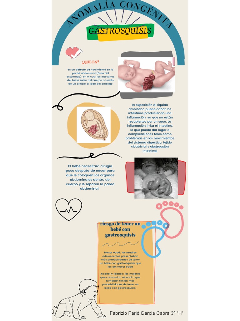 Infografia Malformaciones Congenitas | PDF