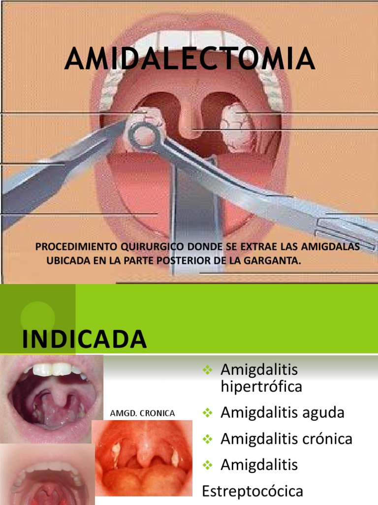 Amigdalectomia - Adenoidetomia | PDF | Cirugía | Especialidades Medicas