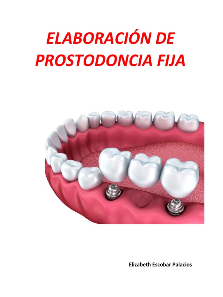Colocación de Pernos en Prostodoncia Fija | PDF | Tornillo | Rieles