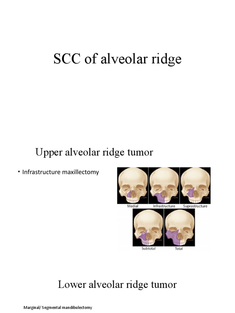 SCC of the Alveolar Ridge: Maxillectomy and Mandibulectomy | PDF