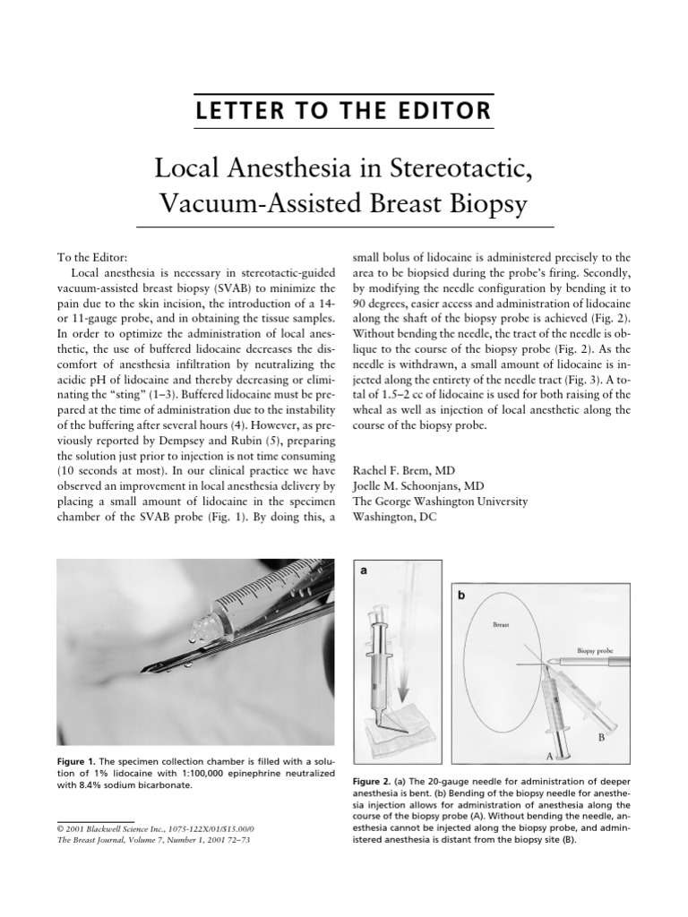 Local Anesthesia in Stereotactic, Vacuum-Assisted Breast Biopsy | PDF ...