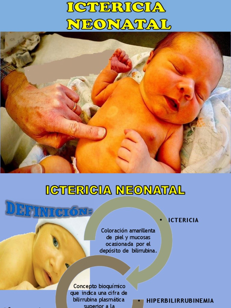 Ictericia Neonatal Diagnóstico Y Tratamiento Pdf Especialidades