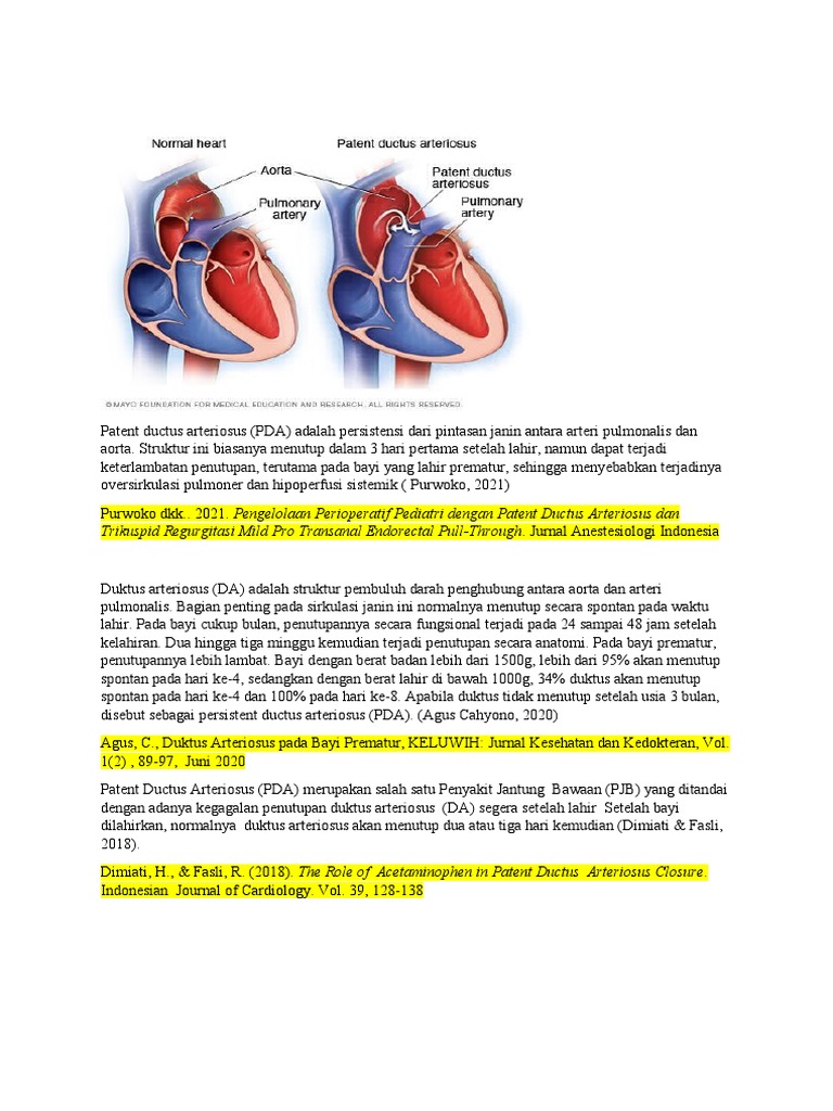 Patent Ductus Arteriosus | PDF