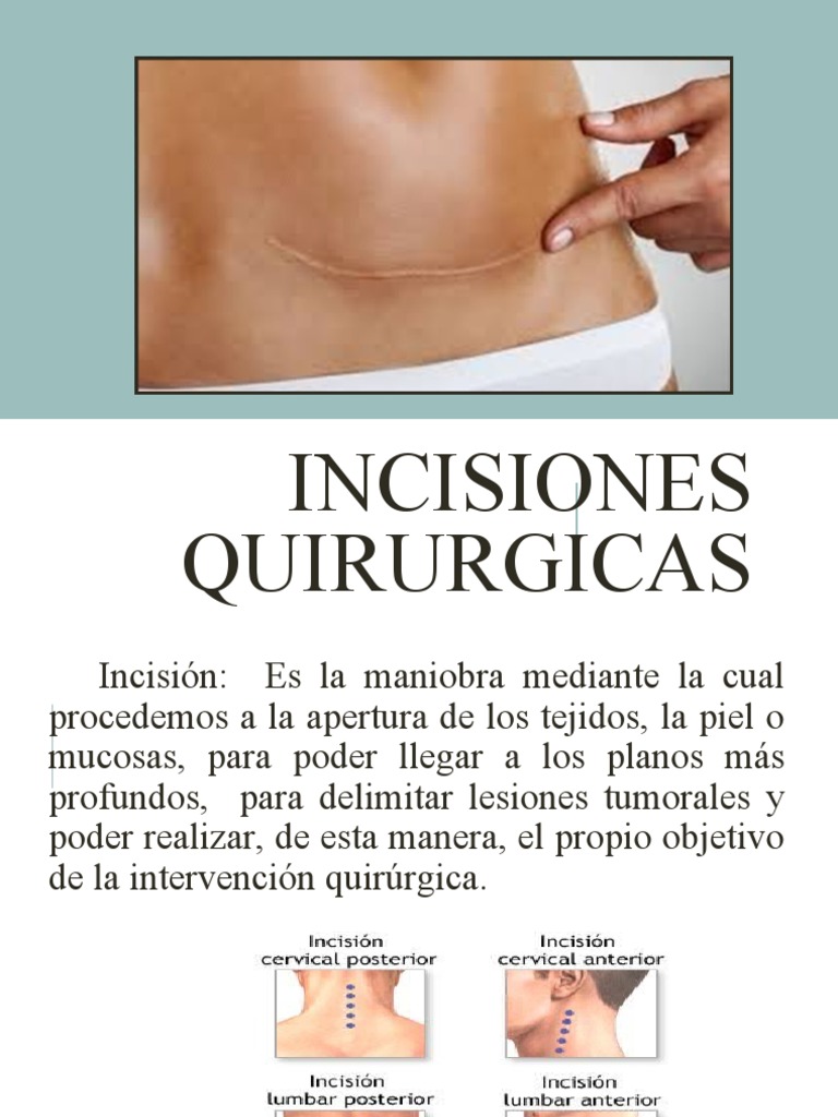 Tipos De Incisiones – Tabla tipos de incisiones quirúrgicas – ZIIIKZ