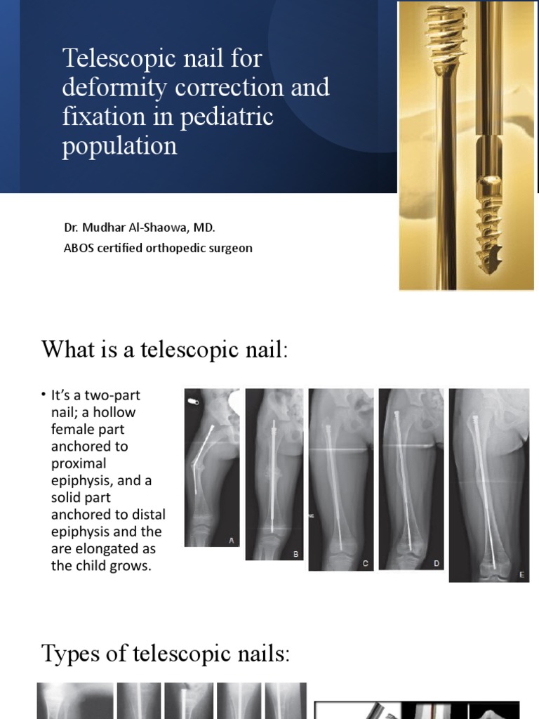 Lecture Telescopic Nail | PDF