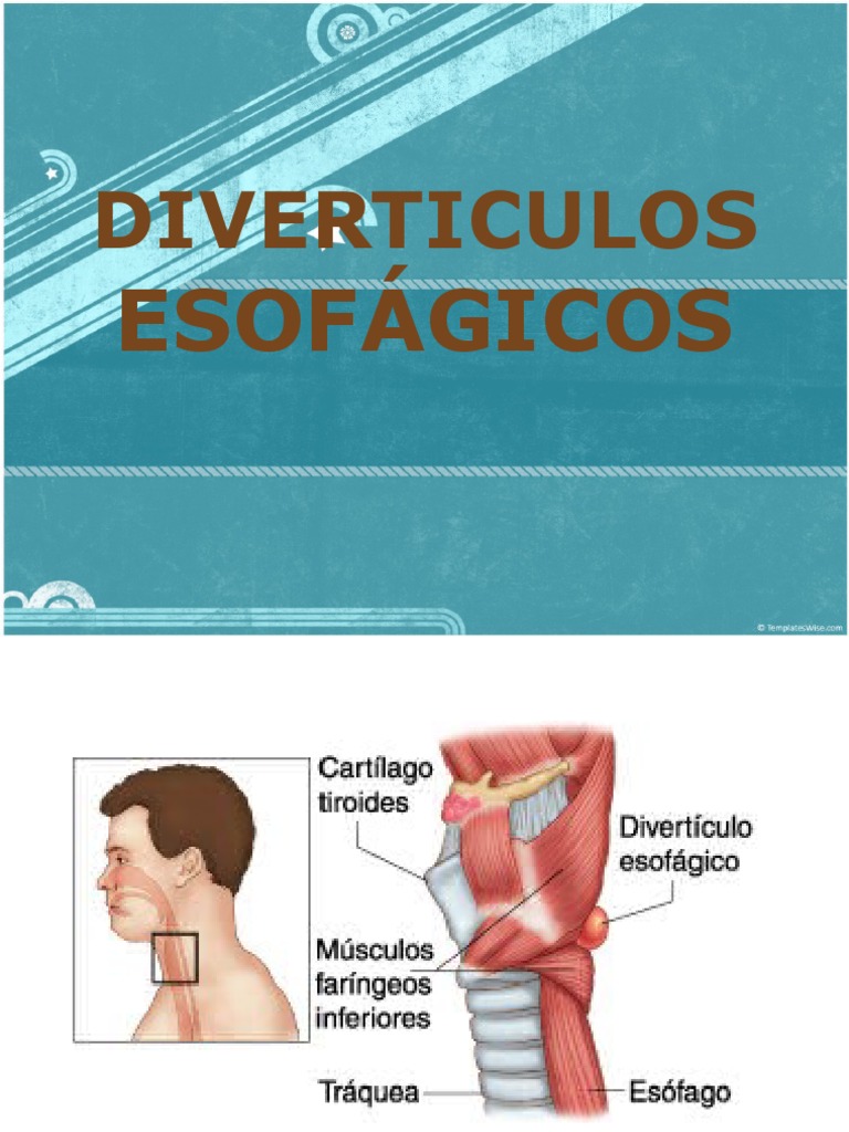 Clasificación de Divertículos Esofágicos | PDF | Esófago ...