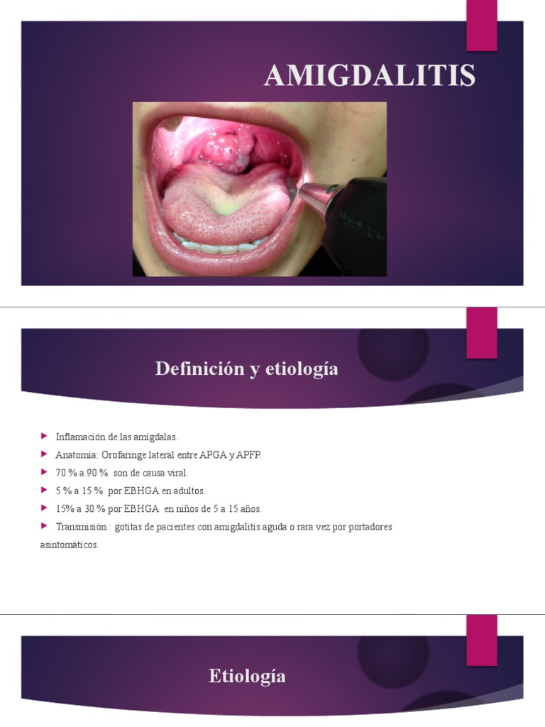 ¿Qué Es La Amigdalitis Viral? | Amigdalitis: contagio, síntomas y ...