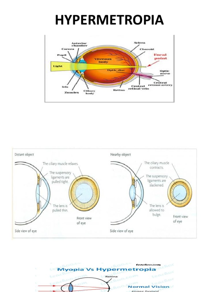 Understanding Hypermetropia: Types and Effects | PDF | Human Eye ...