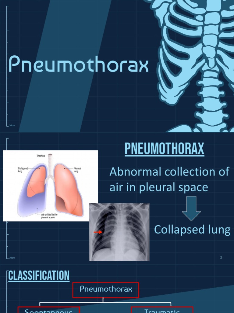 Pneumothorax | PDF | Causes Of Death | Medicine