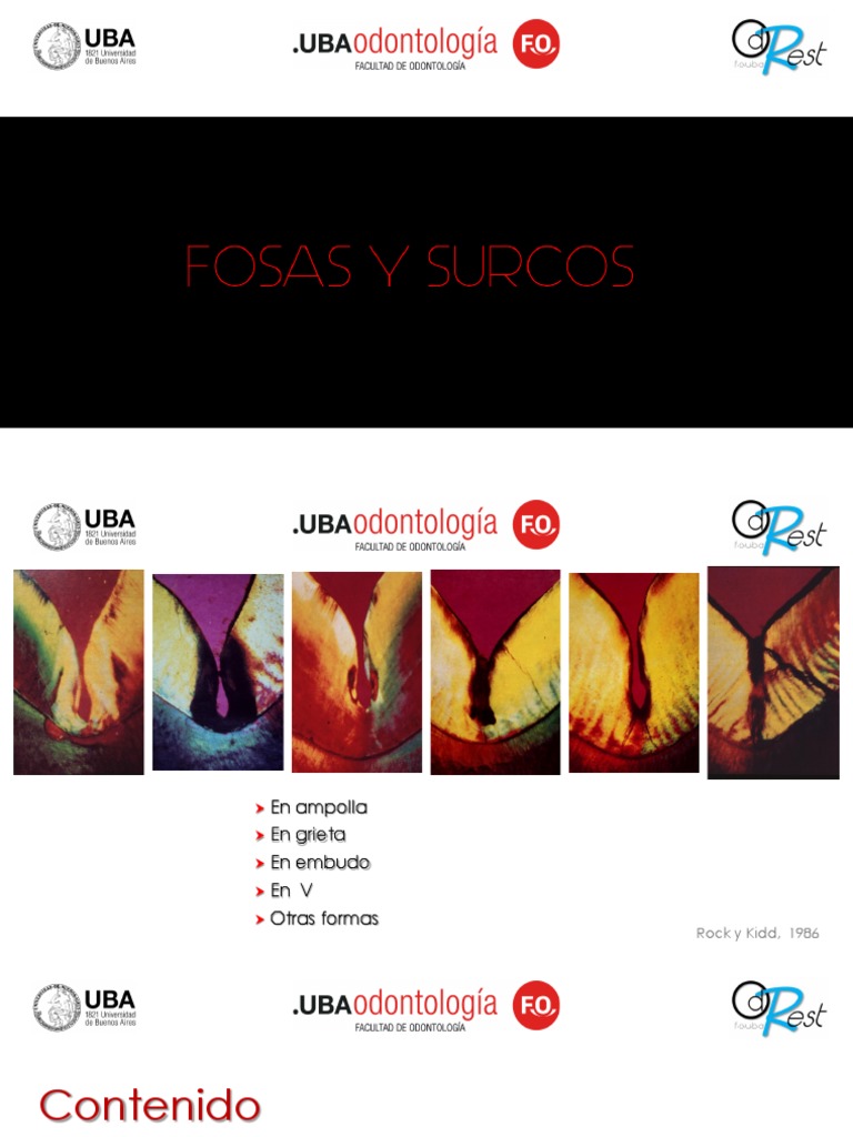 Sellado de Surcos Dentales: Técnicas y Materiales | PDF | Ultrasonido ...