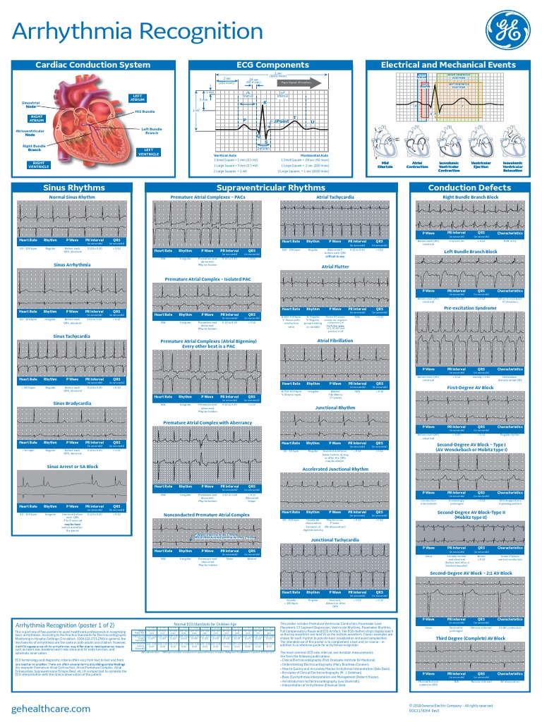 Arrhythmia Recognition Poster Part 1 Pdf Electrocardiography Clinical Medicine 