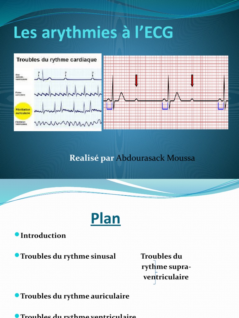 Diagnostic Des Arythmies | PDF | Électrocardiographie | Cœur