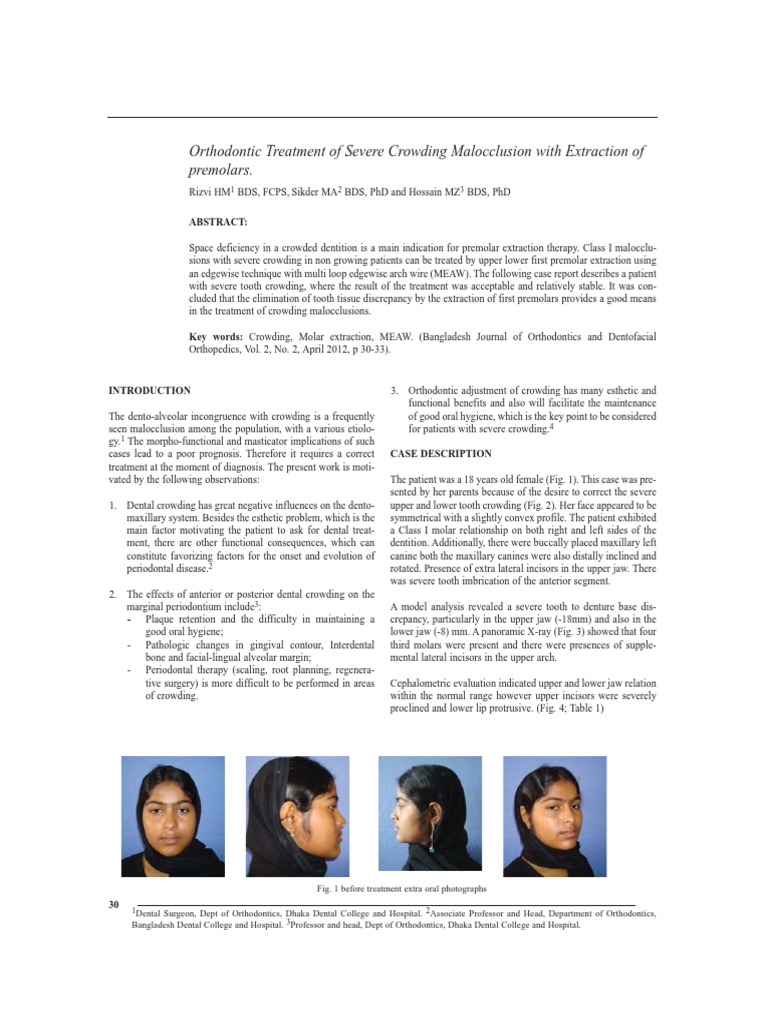 Orthodontic Treatment of Severe Crowding Malocclusion With Extraction ...