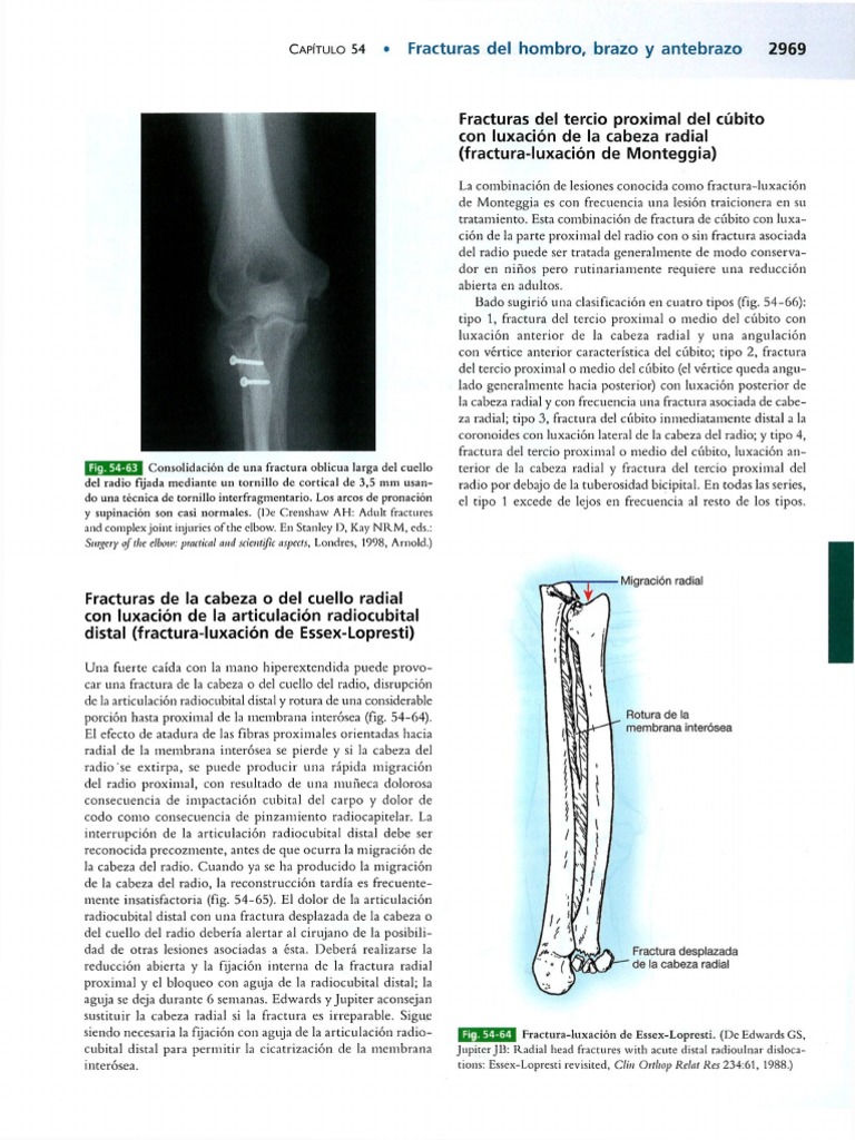 Del Del Cúbito Con Luxación de Radial (Fractura-Luxación de | PDF ...