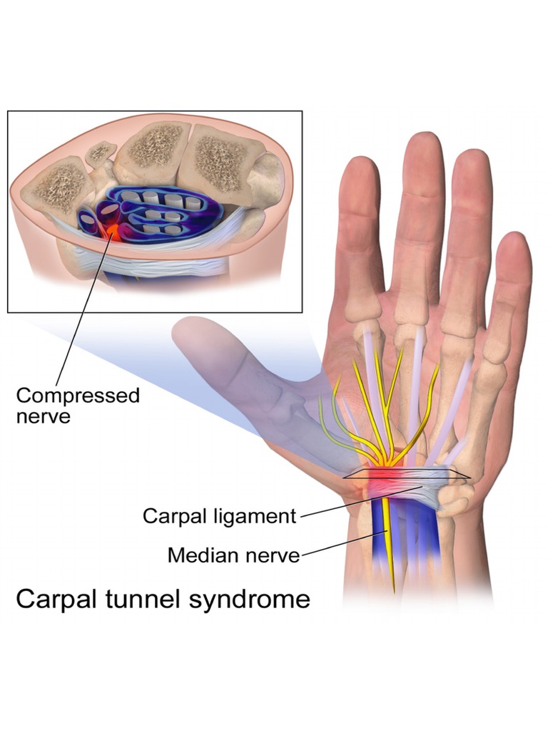 Carpal Tunnel Syndrome Anatomy | PDF