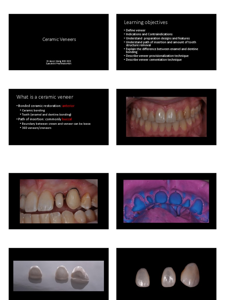 Ceramic Veneers DR Jason Wang | PDF | Tooth Enamel | Health Sciences