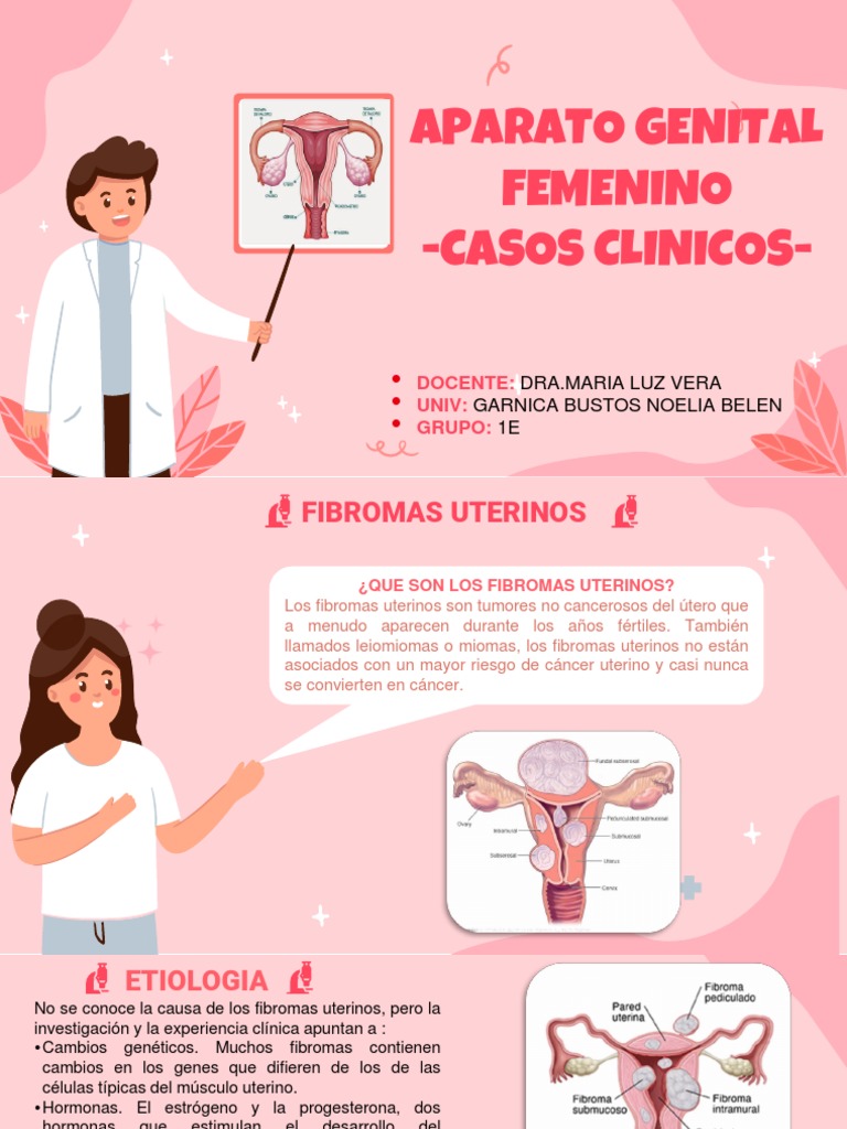 Fibromas Uterinos y Síndrome de Ovario Poliquístico | PDF | Sindrome de ...