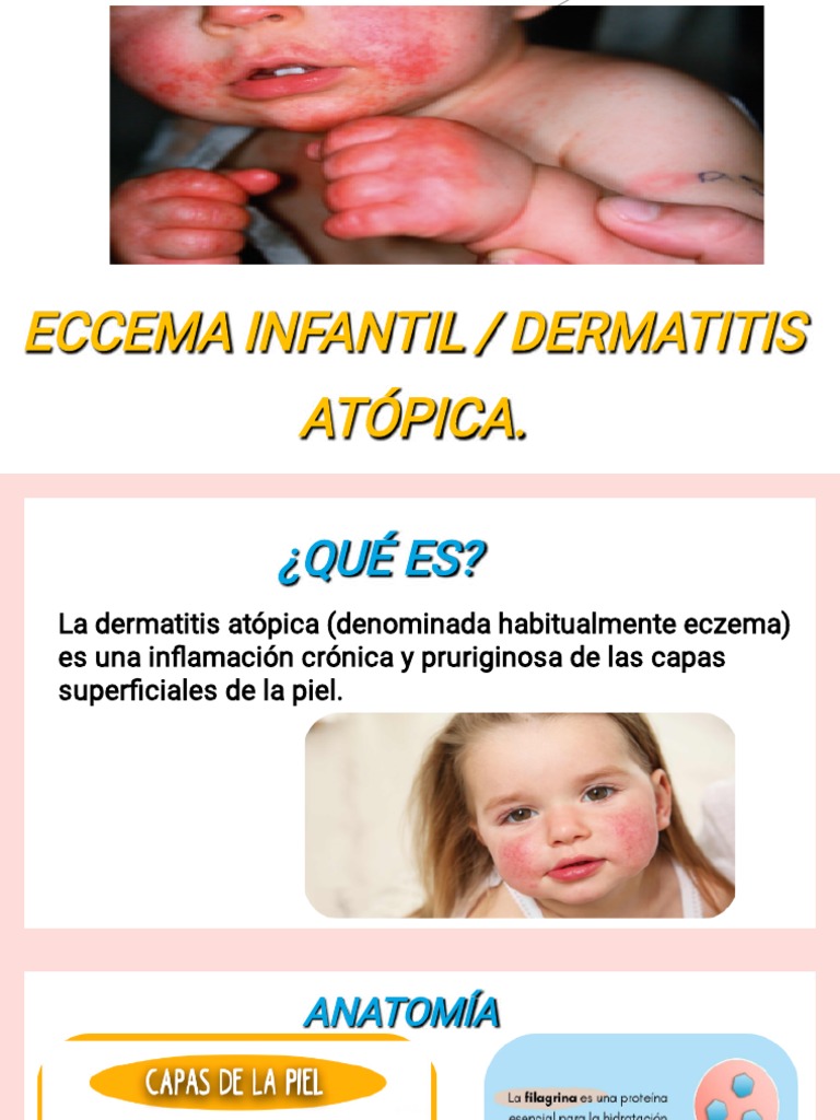 Eccema Infantil / Dermatitis Atópica. Eccema Infantil / Dermatitis ...