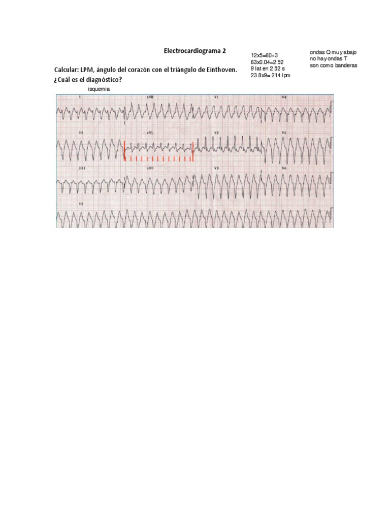 Diagnóstico de EKG III: Isquemia | PDF