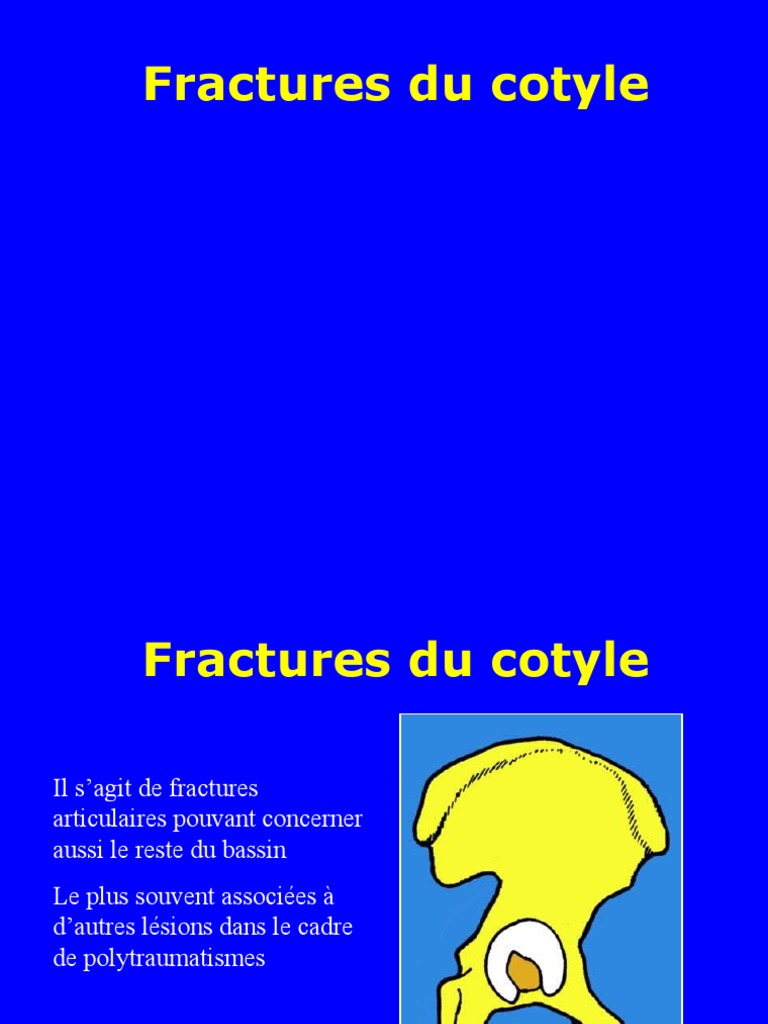 Classification des fractures du cotyle | PDF | Bassin (anatomie ...