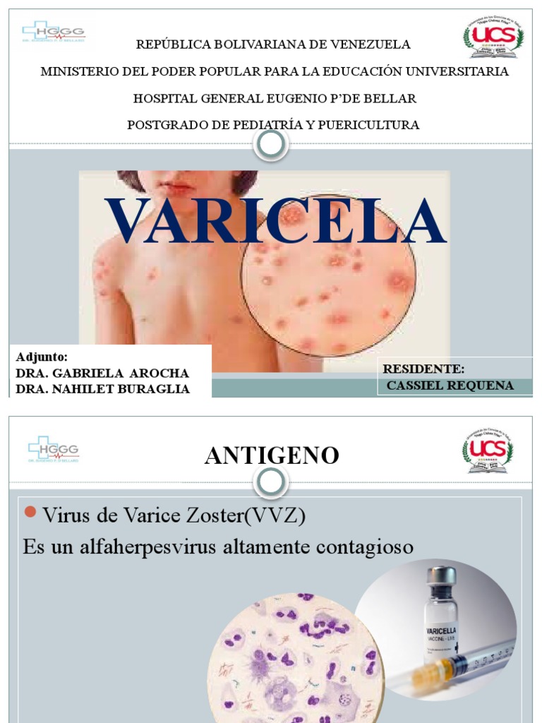 Varicela | PDF