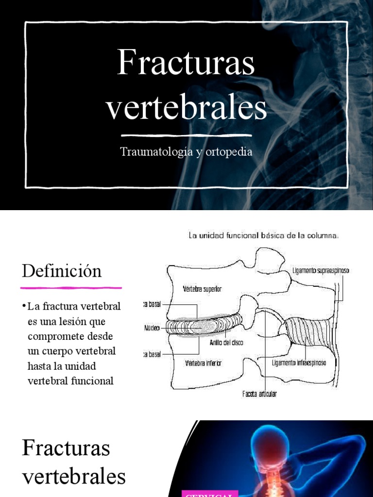 Fracturas Vertebrales | PDF | Medicina | Sistema esquelético