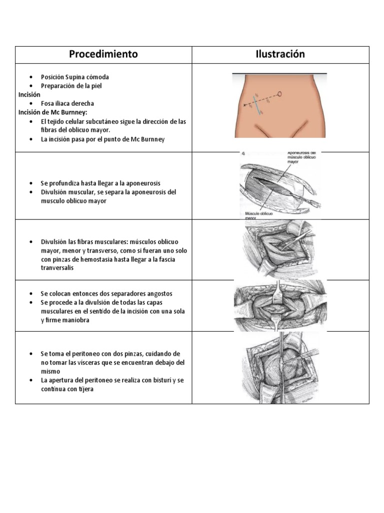 Incisión y técnica en apendicectomía | PDF | Anatomía | Morfología ...
