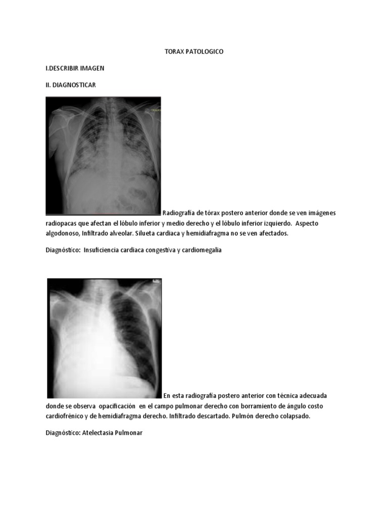 Diagnósticos de Patologías Torácicas | PDF