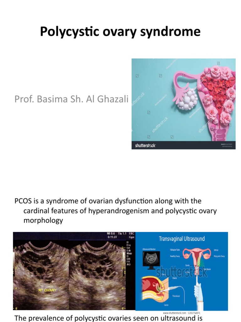 PCOS DR Basima | PDF | Polycystic Ovary Syndrome | Sexual Anatomy