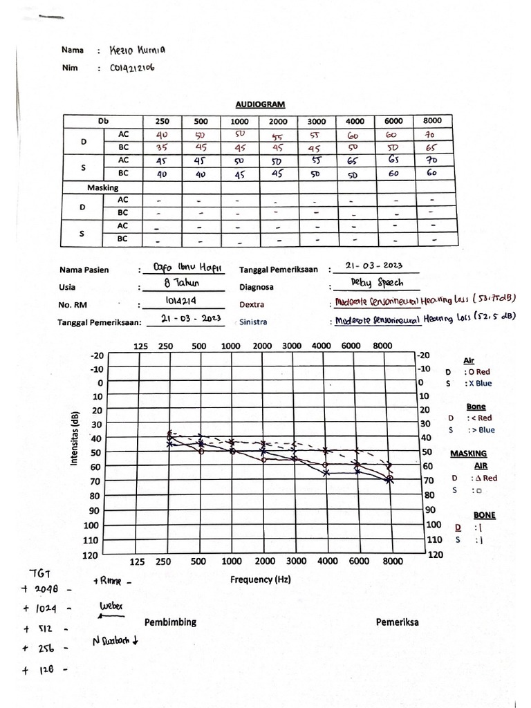 PTA SNHL E.C Speech Delay | PDF