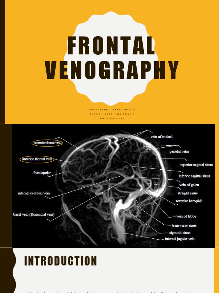 Frontal Venography: Presenter:-Saru Gosain B A T C H: - 2 0 1 7 (3 R D Y E A R) R O L L N O: - 1 ...
