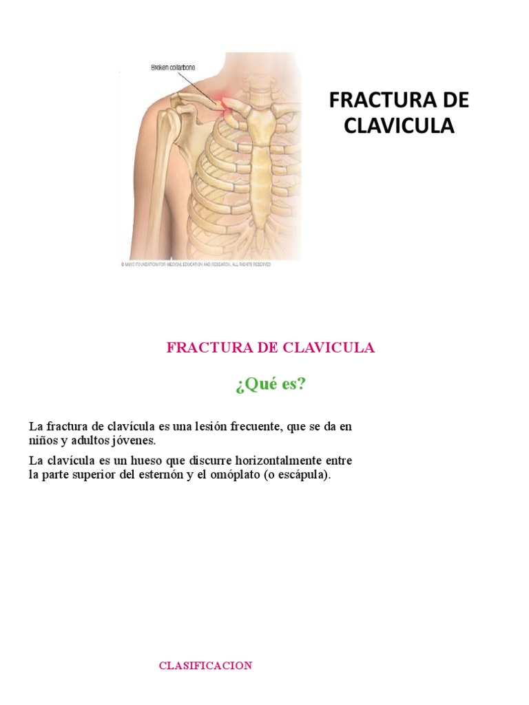 Fractura de Clavicula | PDF | Hombro | Hueso
