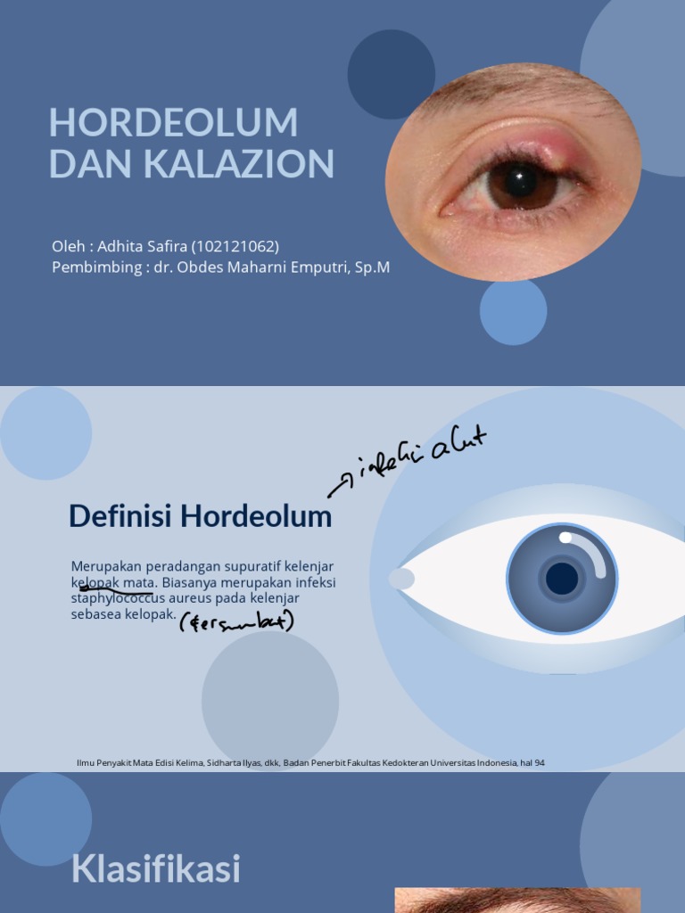 Panduan Hordeolum dan Kalazion | PDF