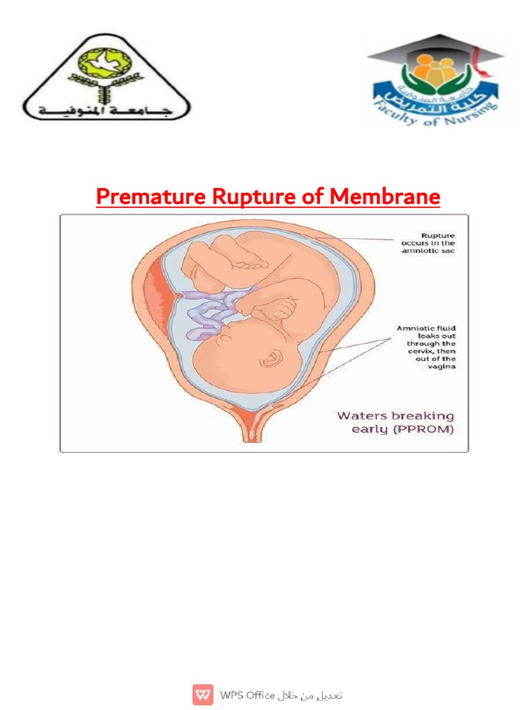 Premature Rupture of Membrane | PDF | Childbirth | Preterm Birth